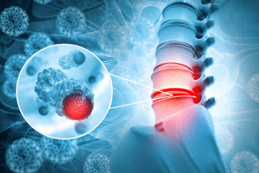 Las etapas o fases del cáncer